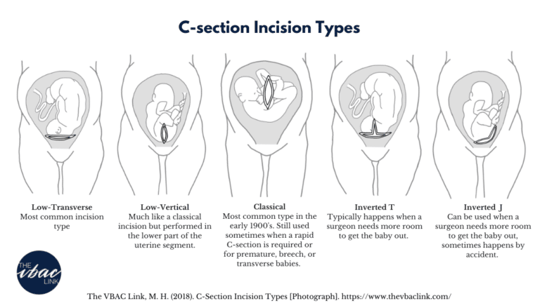 C-Section Incision Types: Learn More About Special Scars