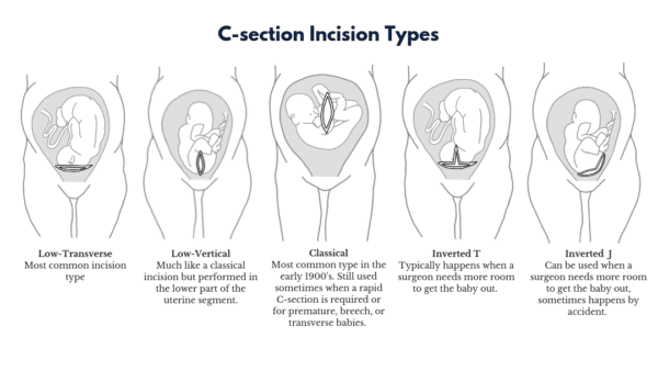 VBAC vs Repeat C-Section: Which is Right for You?